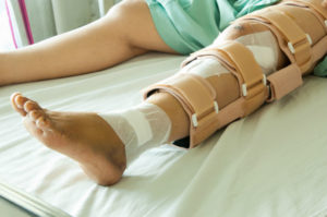 How Orthotics Can Help You Recover from a Fracture