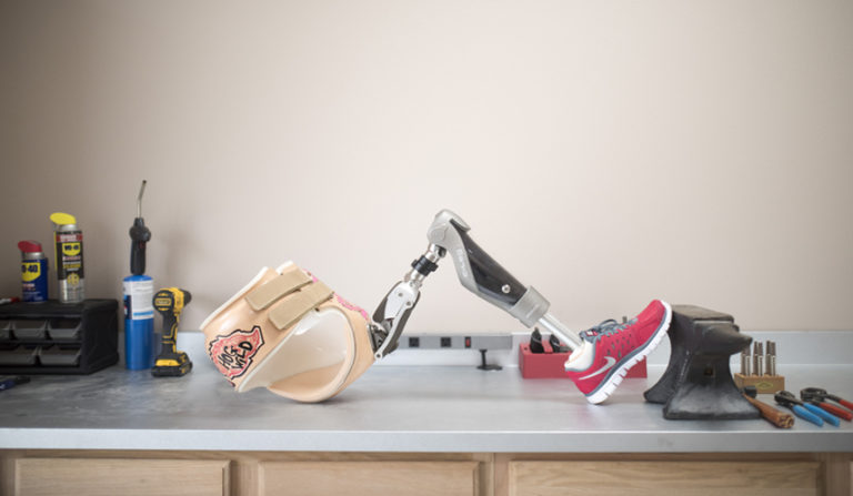 How to Choose the Best Prosthetist for YOU!